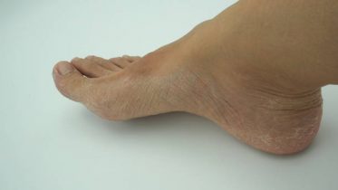 What Causes Skin To Split Under Toes